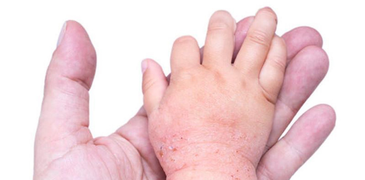 Dermatite (eczema atopico) | Swiss Medical Network